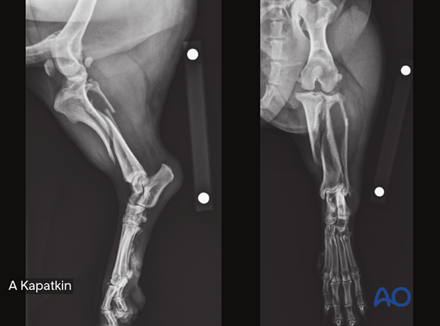 Simple articular, simple metaphyseal fracture