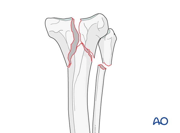 Styloid Process Of Tibia Fracture