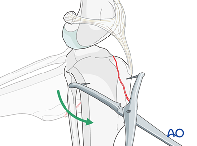K-wire fixation for Avulsion fracture