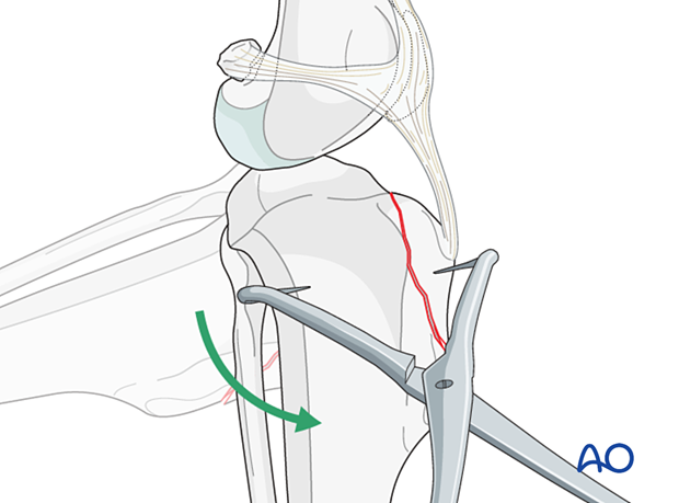 K-wire and tension band fixation for Avulsion fracture