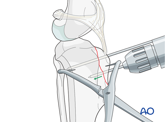K-wire and tension band fixation for Avulsion fracture