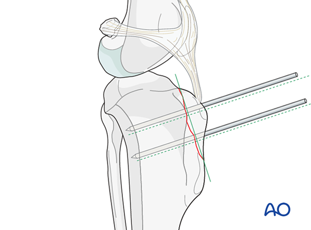 K-wire fixation for Avulsion fracture