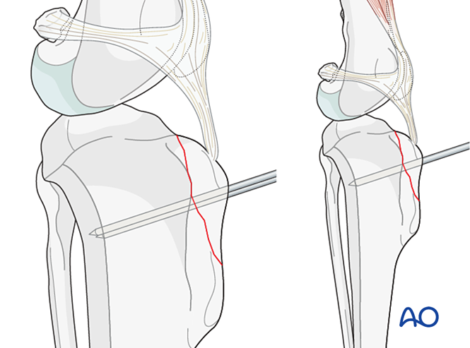 K-wire and tension band fixation for Avulsion fracture