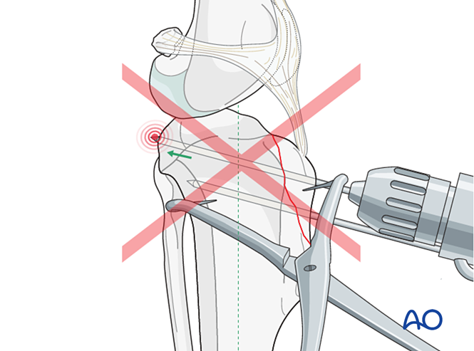 K-wire fixation for Avulsion fracture