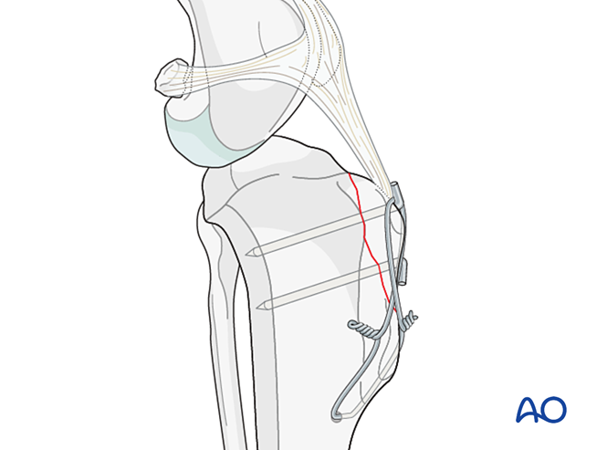 K-wire fixation