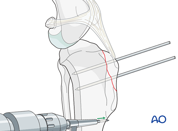 K-wire and tension band fixation for Avulsion fracture
