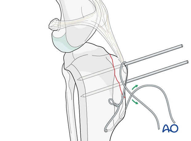 K-wire and tension band fixation for Avulsion fracture