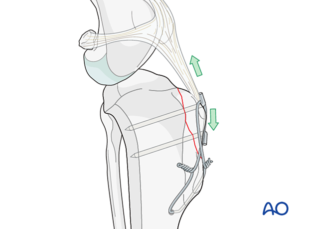 K-wire and tension band fixation for Avulsion fracture