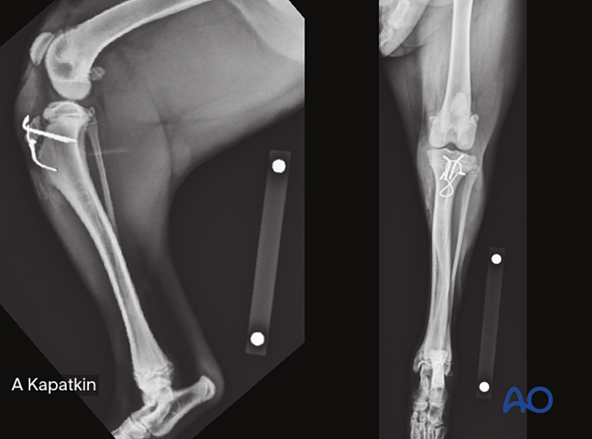 K-wire and tension band fixation for Avulsion fracture