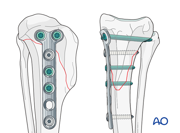 Bone plate fixation for Simple extraarticular fracture