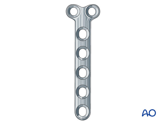 Bone plate fixation for Simple extraarticular fracture