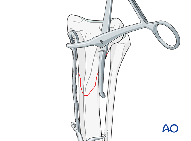Bone plate fixation for Simple extraarticular fracture