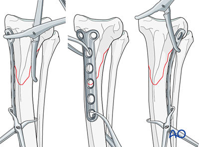 Bone plate fixation for Simple extraarticular fracture