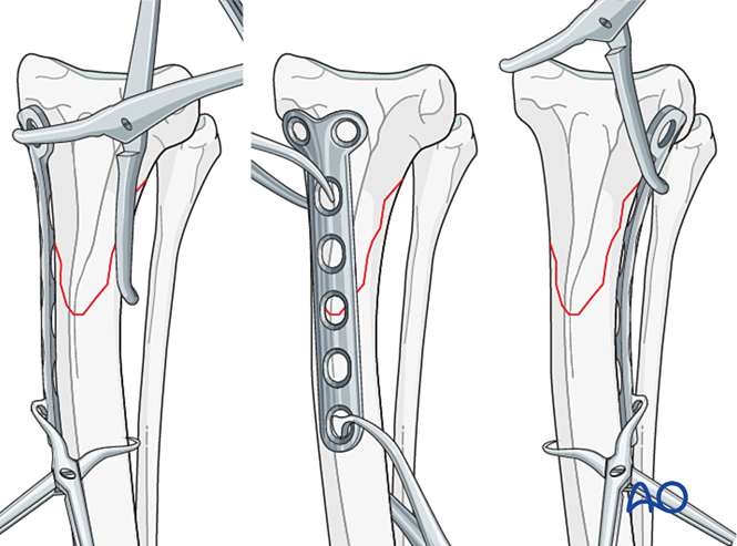 Bone plate fixation for Simple extraarticular fracture