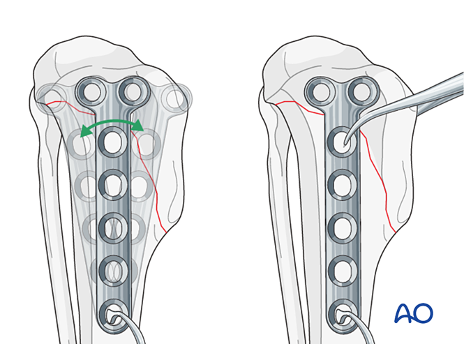 Bone plate fixation for Simple extraarticular fracture