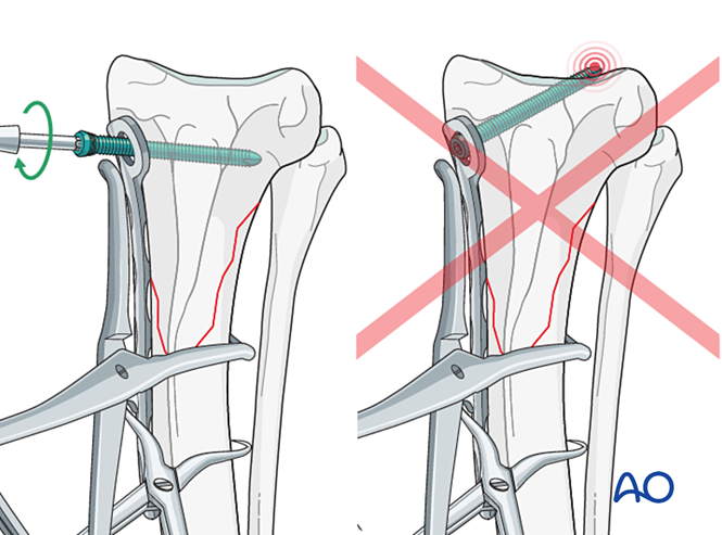 Bone plate fixation for Simple extraarticular fracture