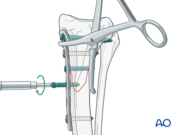 Bone plate fixation for Simple extraarticular fracture