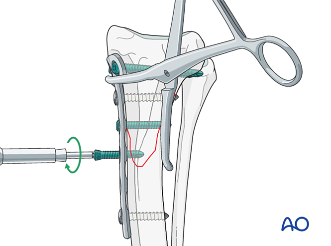 Bone plate fixation for Simple extraarticular fracture