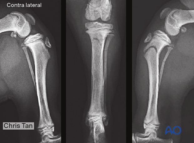 Bone plate fixation for Simple extraarticular fracture