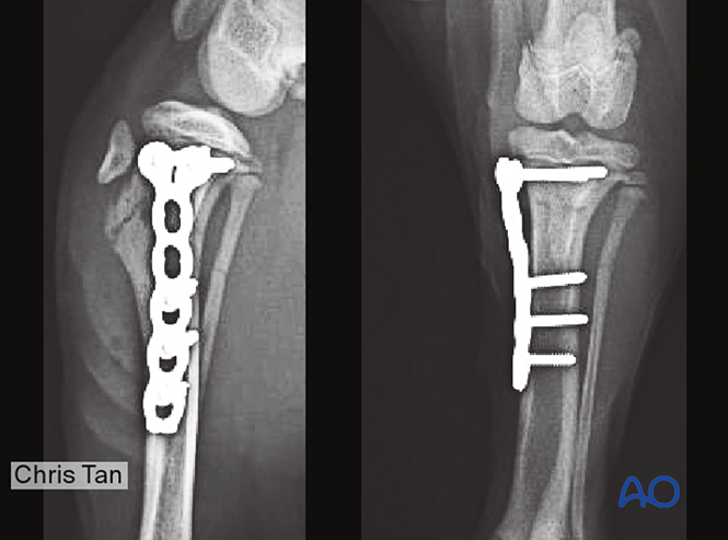 Bone plate fixation for Simple extraarticular fracture