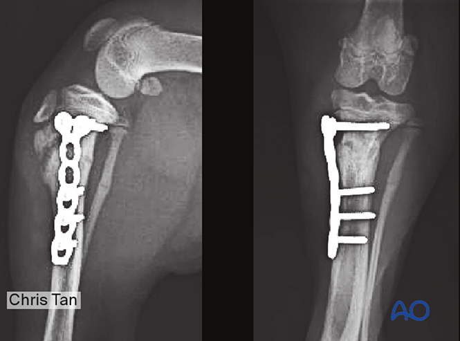 Bone plate fixation for Simple extraarticular fracture