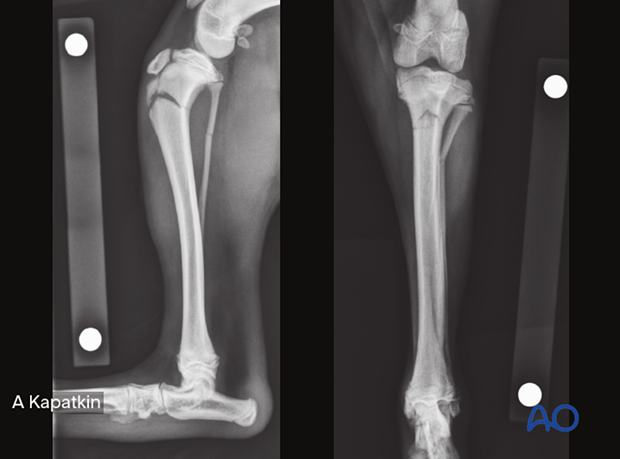 Bone plate fixation for Simple extraarticular fracture