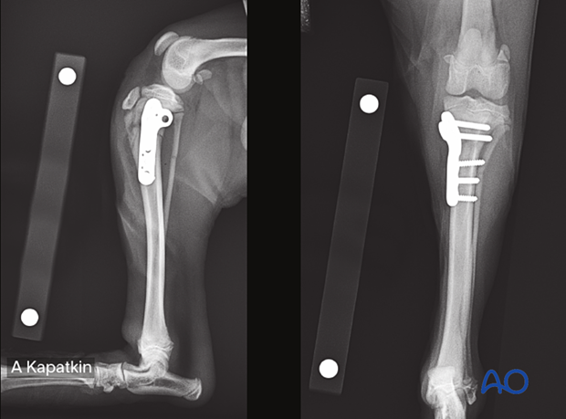 Bone plate fixation for Simple extraarticular fracture
