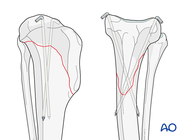 K-wire fixation for Simple extraarticular fracture