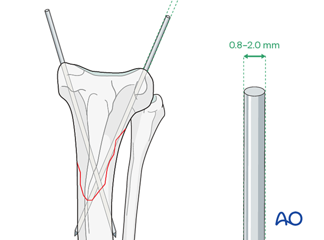 K-wire fixation for Simple extraarticular fracture