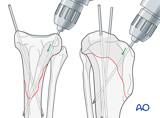 K-wire fixation for Simple extraarticular fracture