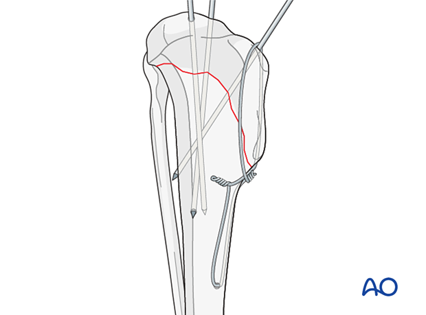 K-wire fixation for Simple extraarticular fracture