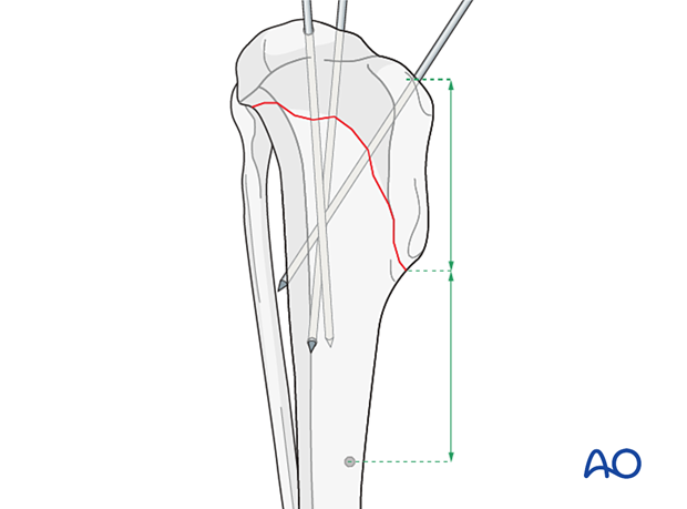 K-wire fixation for Simple extraarticular fracture