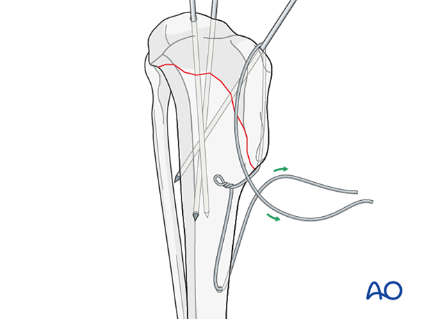 K-wire fixation for Simple extraarticular fracture
