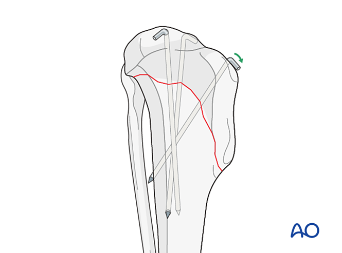 K-wire fixation for Simple extraarticular fracture