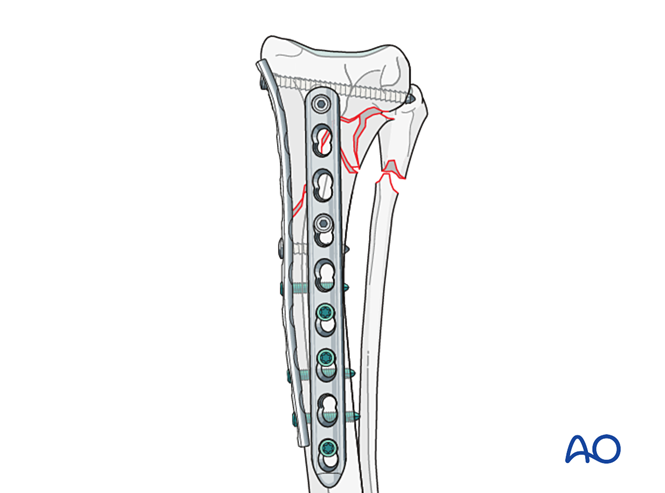Bridging plate and screw fixation for Multifragmentary extraarticular ...