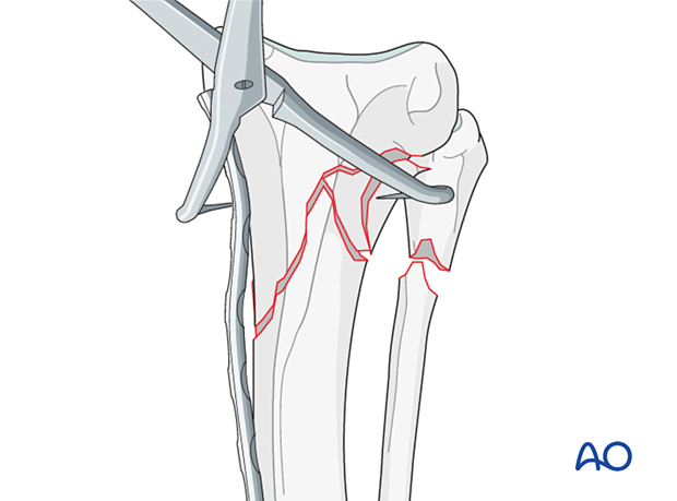 Bridging plate and screw fixation for Multifragmentary extraarticular ...