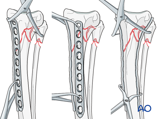 Bridging plate and screw fixation for Multifragmentary extraarticular ...