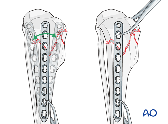 Bridging plate and screw fixation for Multifragmentary extraarticular ...