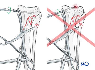 Bridging plate and screw fixation for Multifragmentary extraarticular ...