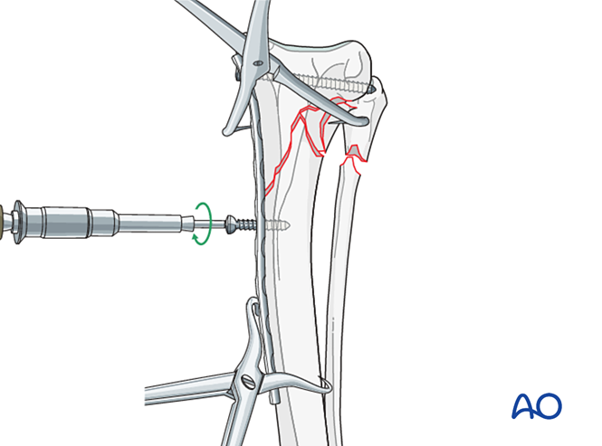 Bridging plate and screw fixation for Multifragmentary extraarticular ...
