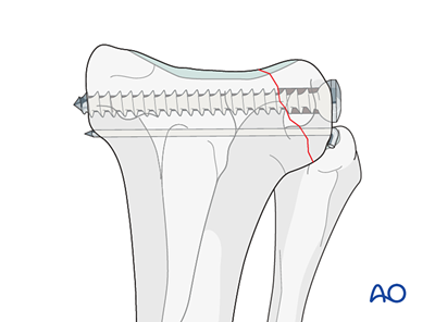 K-wire fixation