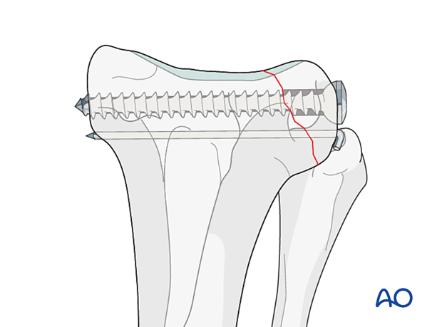 Lag screw and K-wire fixation for Lateral simple partial articular fracture