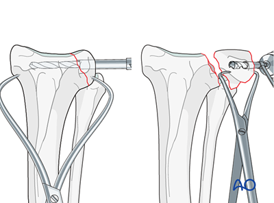 Lag screw and buttress plate fixation for Lateral simple partial ...