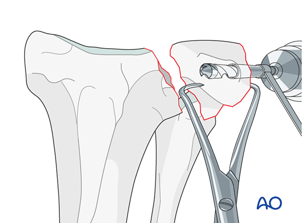 Lag screw and buttress plate fixation for Lateral simple partial ...