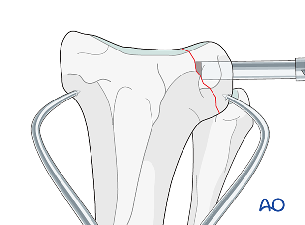Lag screw and buttress plate fixation for Lateral simple partial ...