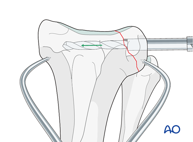 Lag screw and buttress plate fixation for Lateral simple partial ...