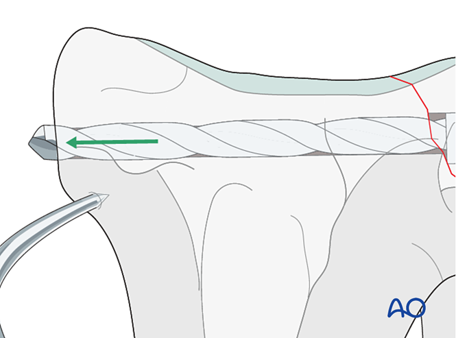 Lag screw and buttress plate fixation for Lateral simple partial ...