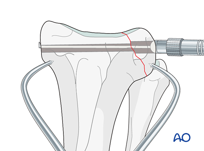 Lag screw and K-wire fixation for Lateral simple partial articular fracture