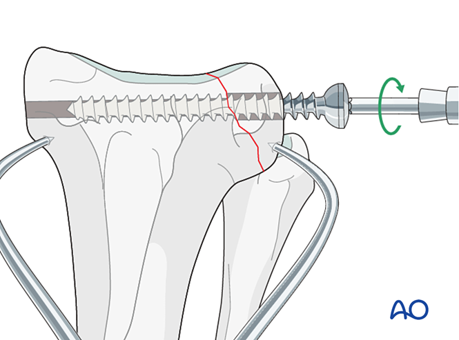 Lag screw and K-wire fixation for Lateral simple partial articular fracture