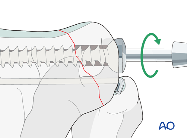 Lag screw and K-wire fixation for Lateral simple partial articular fracture